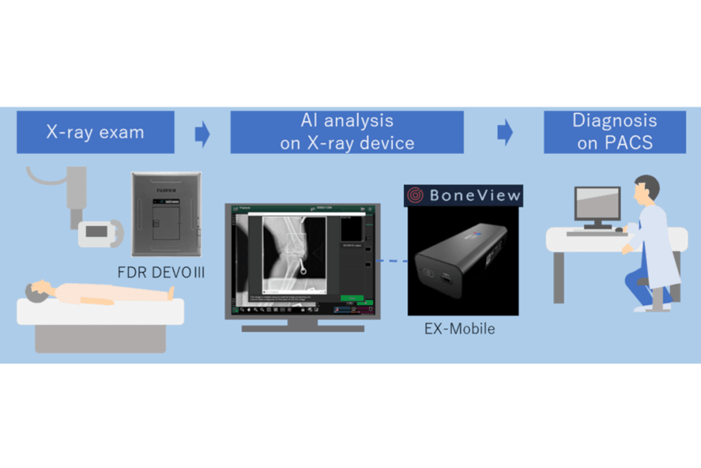 Fujifilm integrates AI software to help identify bone trauma at the ...