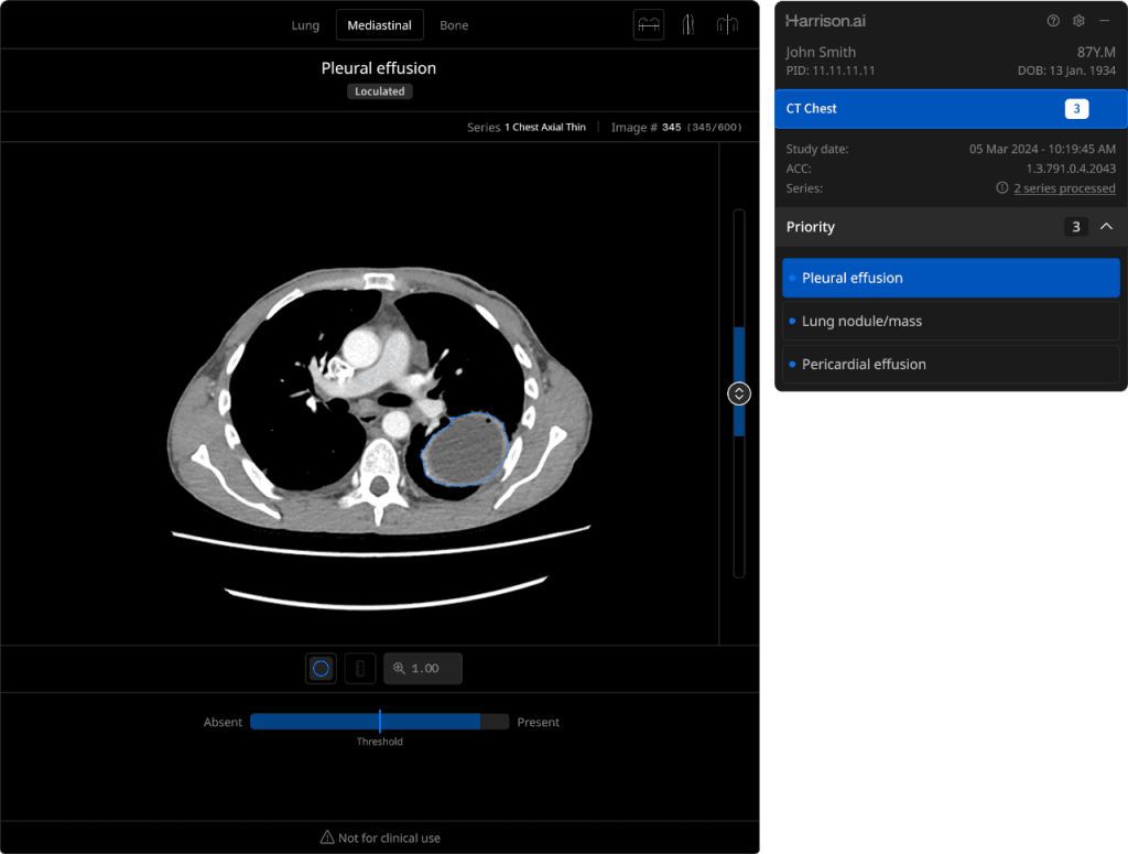 Success of chest x-ray AI tool leads to introduction of CT Chest by ...
